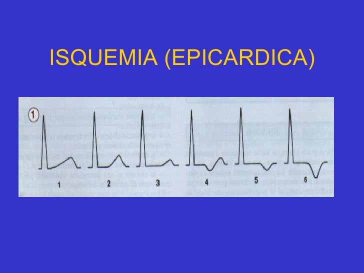 Ecg Ii Isquemia