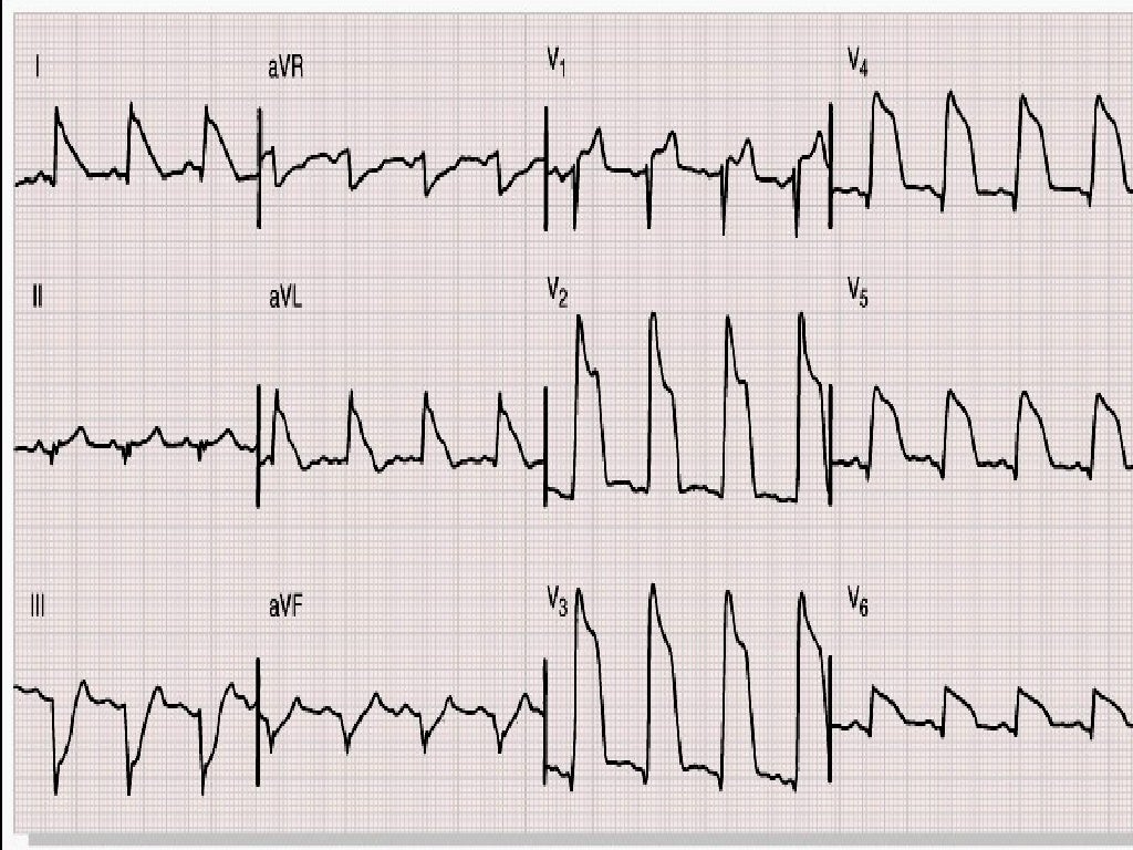 Ecg Ii Isquemia