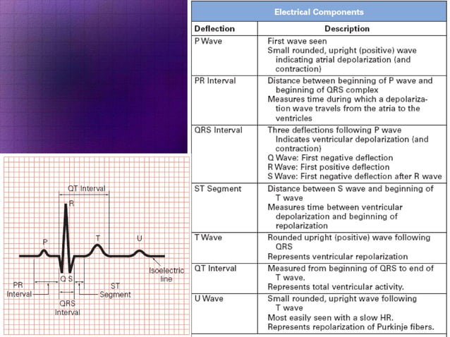 Ecg in acs | PPTX | Heart and Cardiovascular Diseases | Diseases and ...