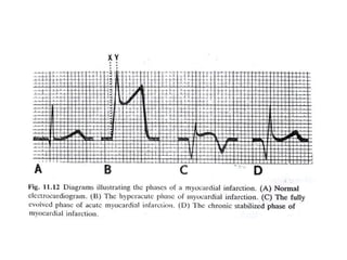 Ecg in ACS | PPT