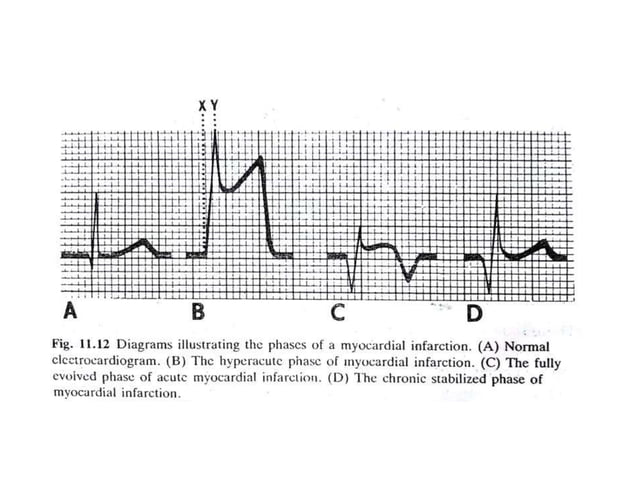 Ecg in ACS | PPT