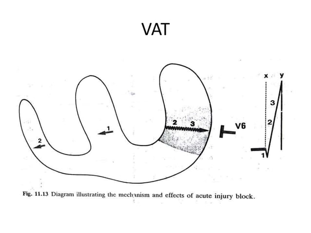 Ecg in ACS | PPT