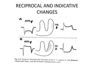 Ecg in ACS | PPT