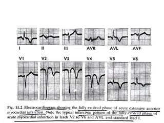 Ecg in ACS | PPT