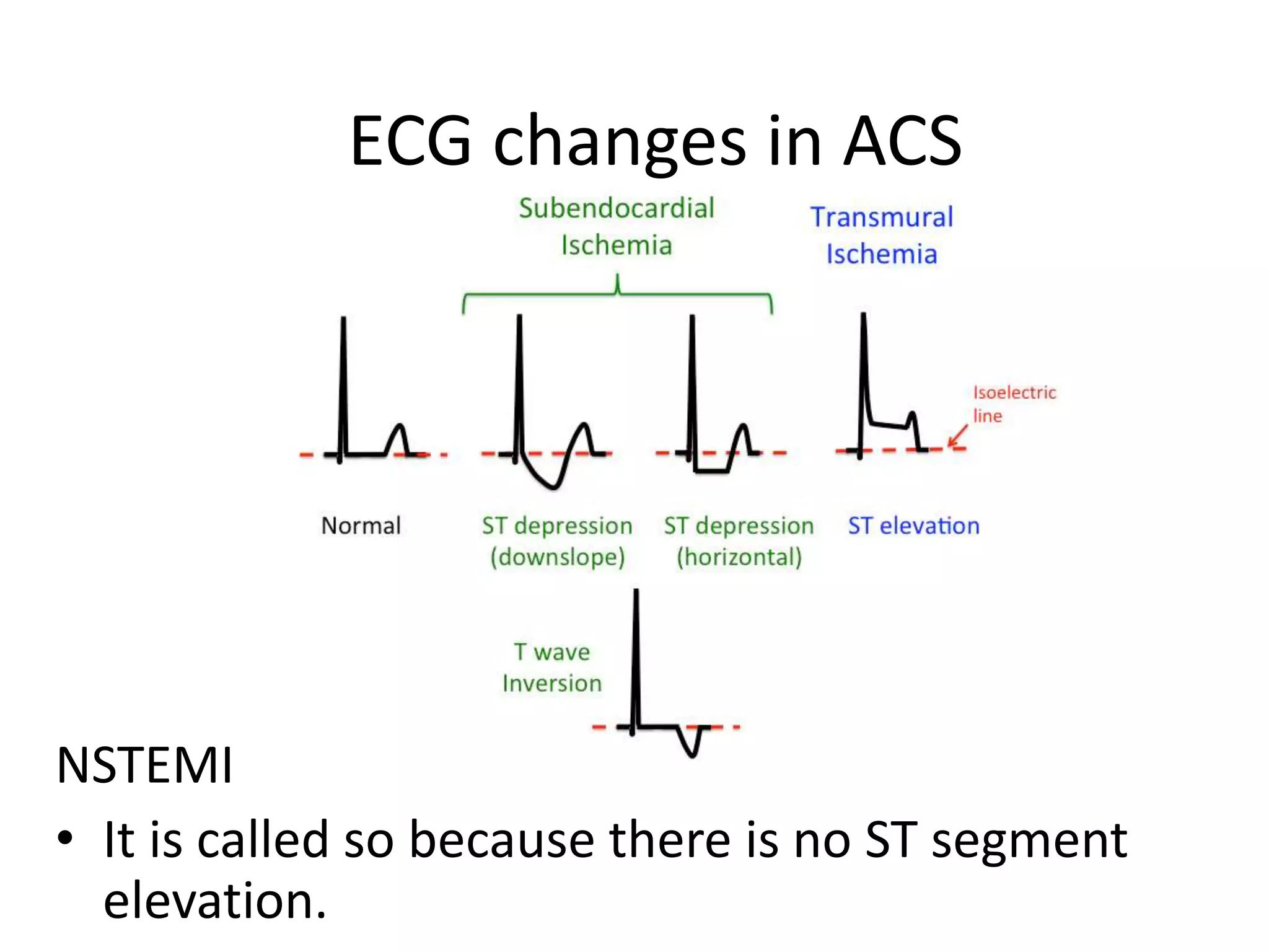 Ecg in acute coronary syndrome and acute care | PPT