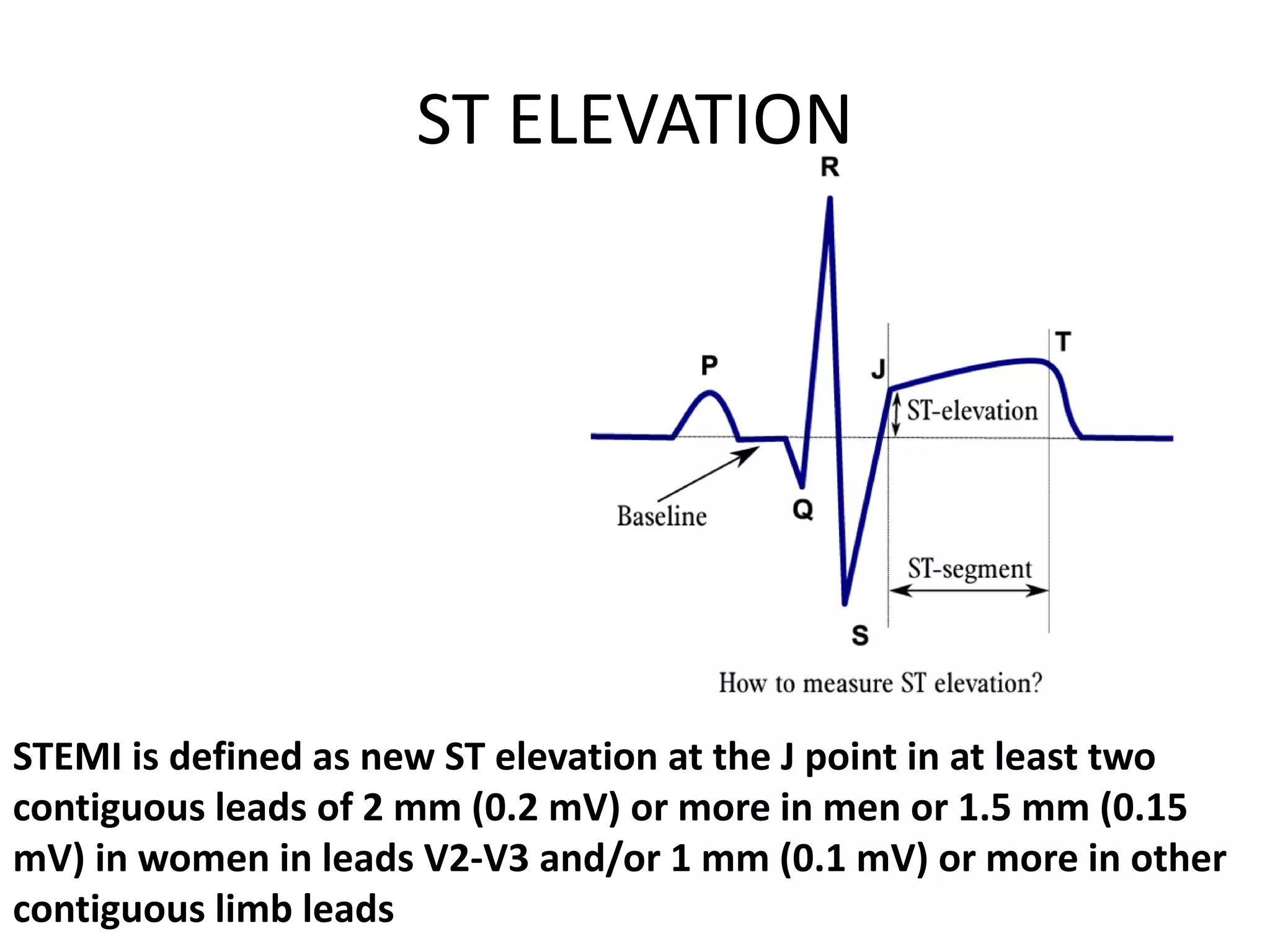 Ecg in acute coronary syndrome and acute care | PPT