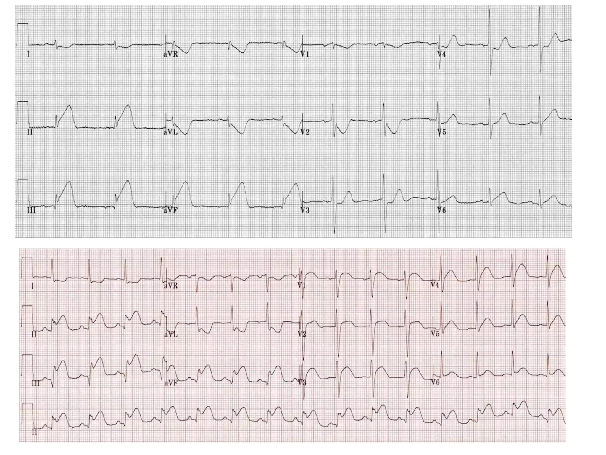 Ecg in acute coronary syndrome and acute care | PPT