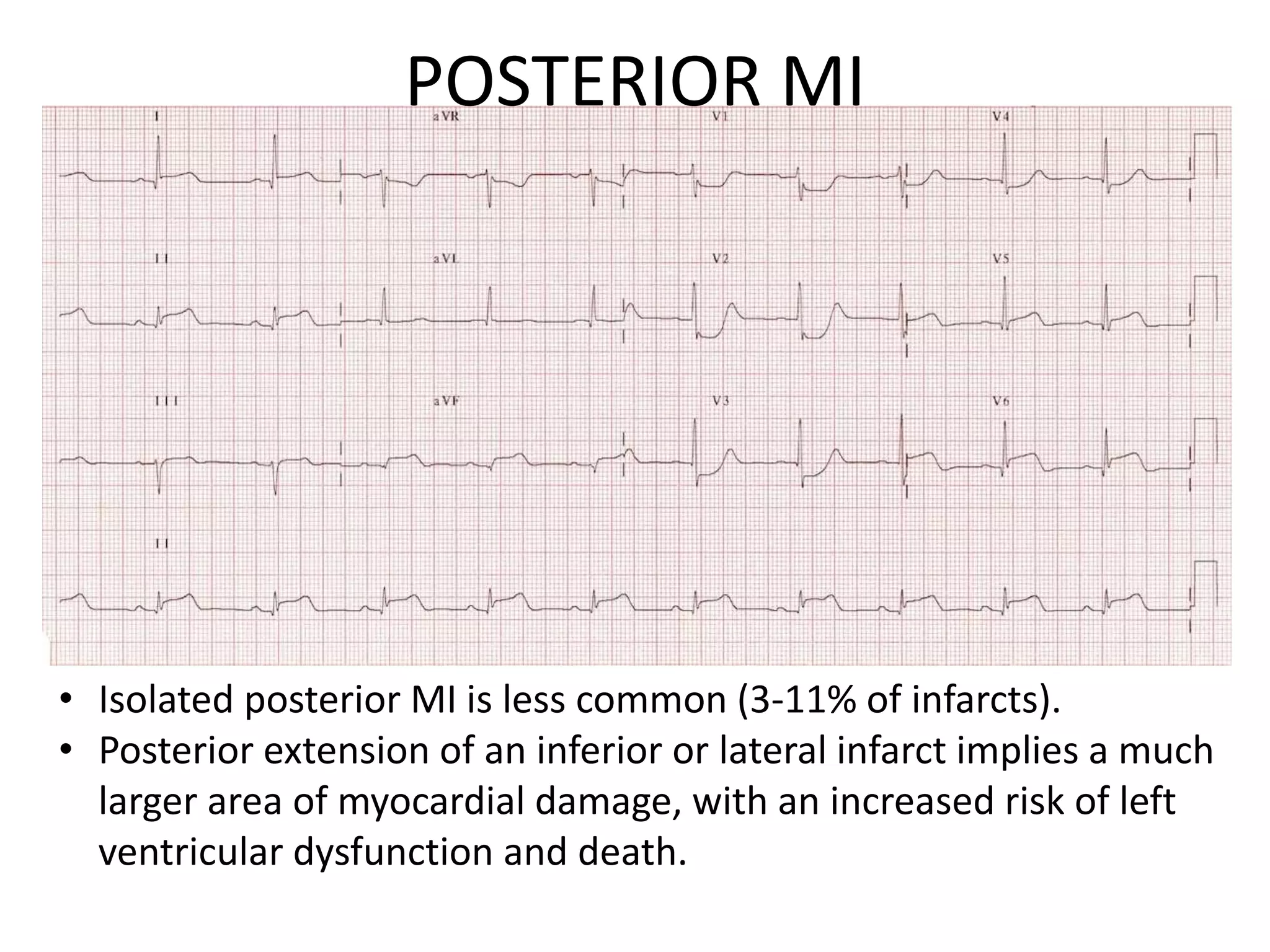 Ecg in acute coronary syndrome and acute care | PPT