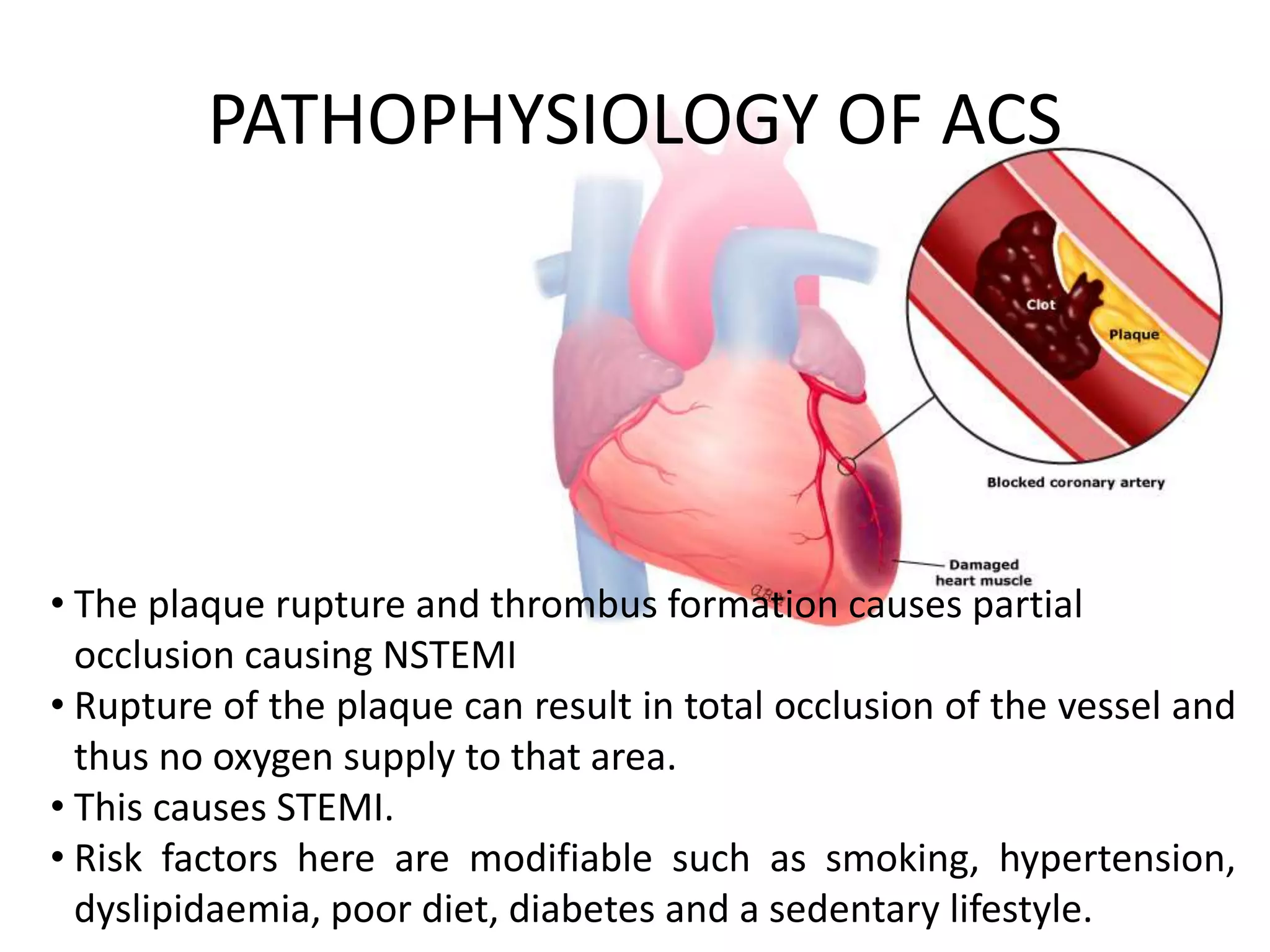 Ecg in acute coronary syndrome and acute care | PPT | Heart and ...