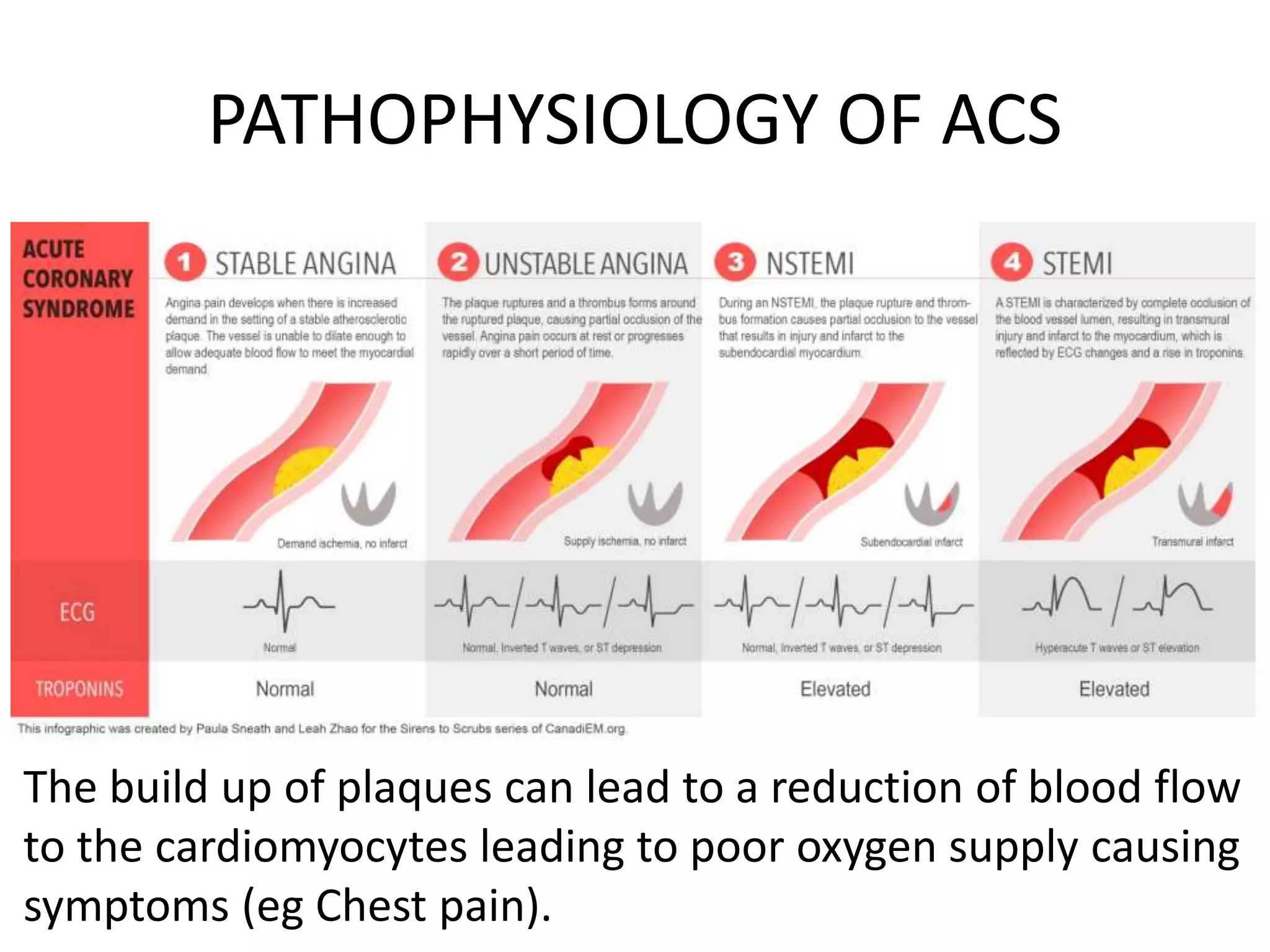 Ecg in acute coronary syndrome and acute care | PPT | Heart and ...