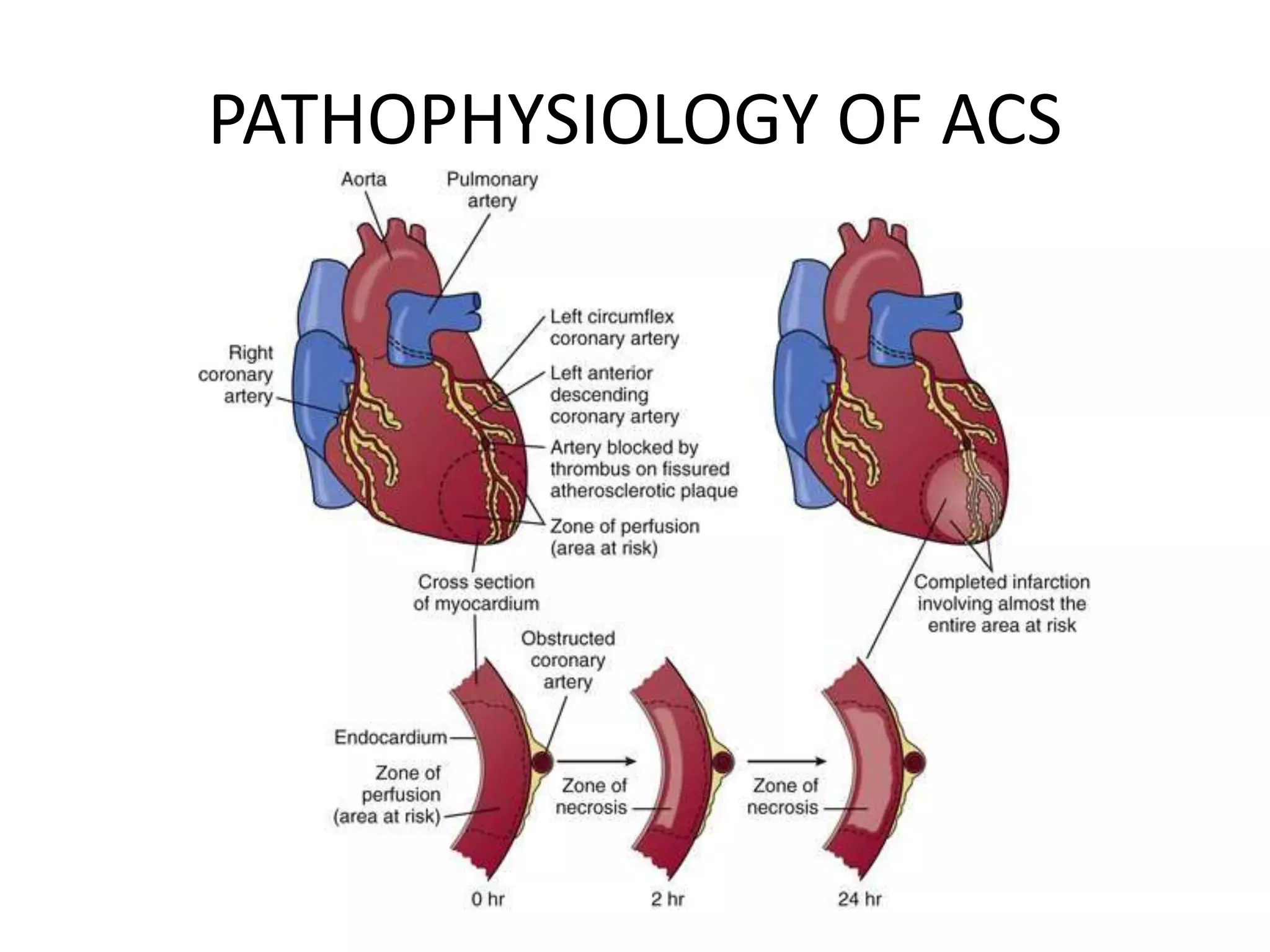 Ecg in acute coronary syndrome and acute care | PPT | Heart and ...
