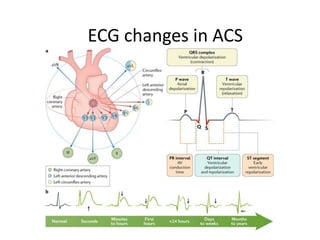 Ecg in acute coronary syndrome and acute care | PPT