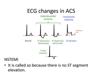 Ecg in acute coronary syndrome and acute care | PPT