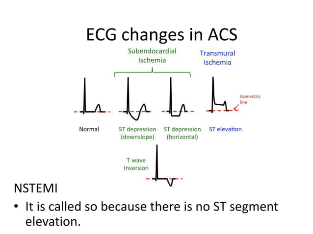 Ecg in acute coronary syndrome and acute care | PPT | Heart and ...