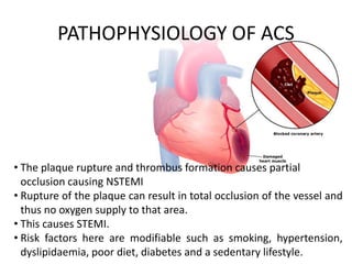 Ecg in acute coronary syndrome and acute care | PPT | Heart and ...