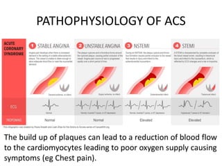Ecg in acute coronary syndrome and acute care | PPT