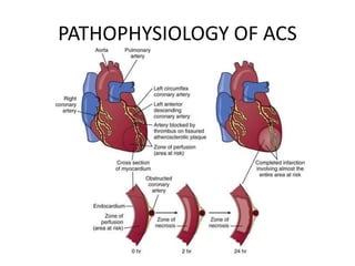 Ecg in acute coronary syndrome and acute care | PPT