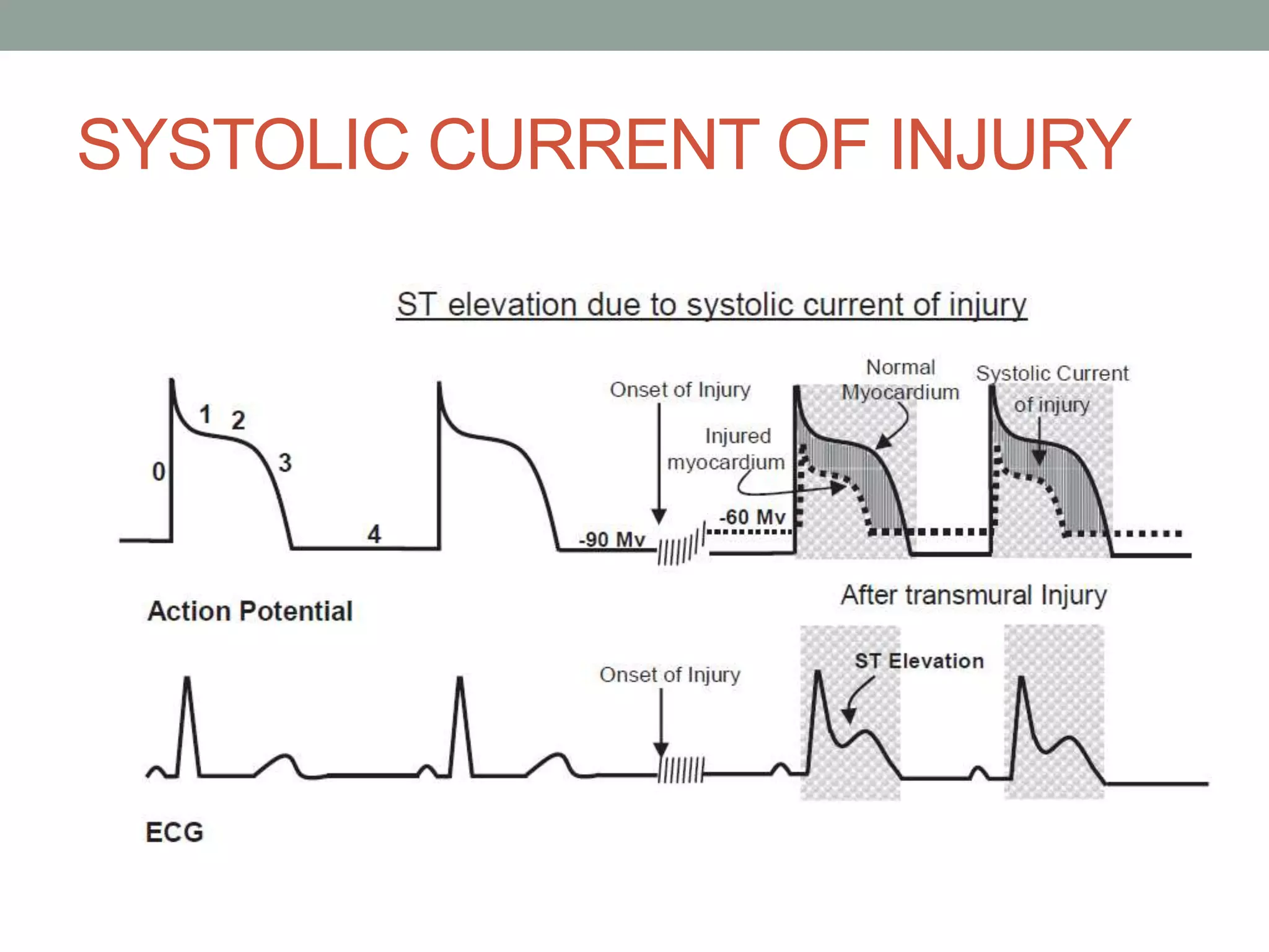 ECG in Acute Myocardial Infarction | PPTX