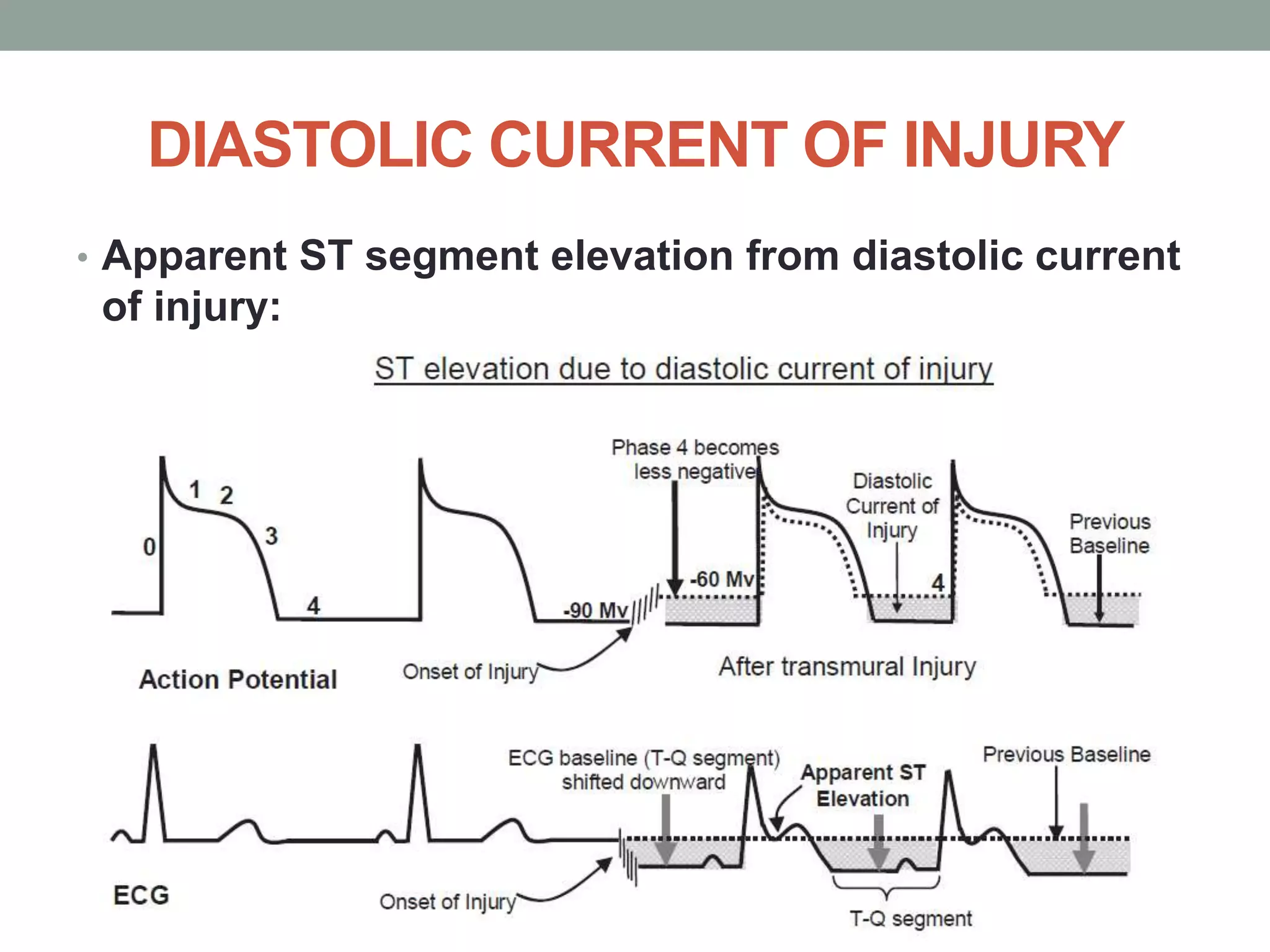 ECG in Acute Myocardial Infarction | PPTX
