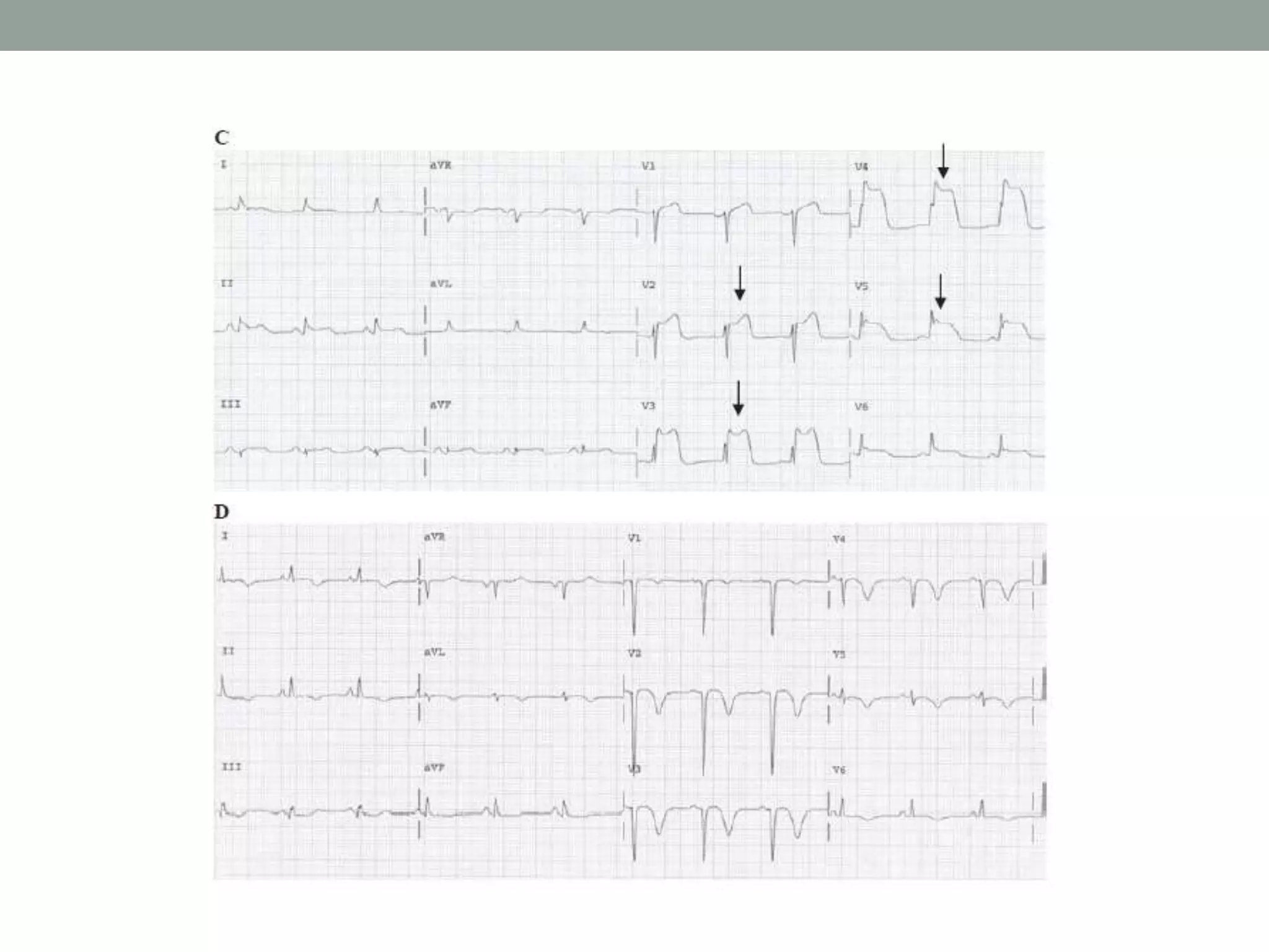 ECG in Acute Myocardial Infarction | PPTX