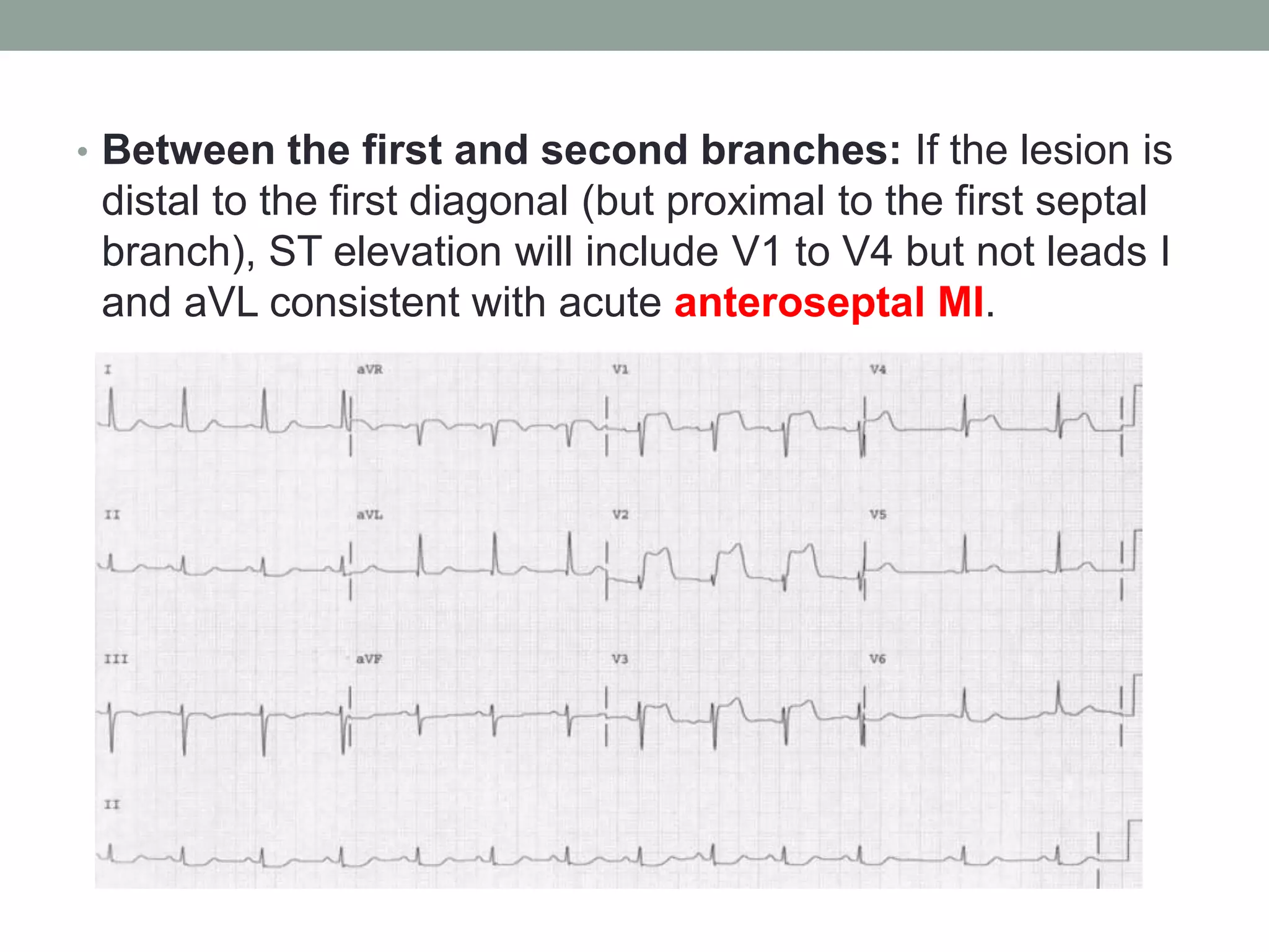 ECG in Acute Myocardial Infarction | PPTX