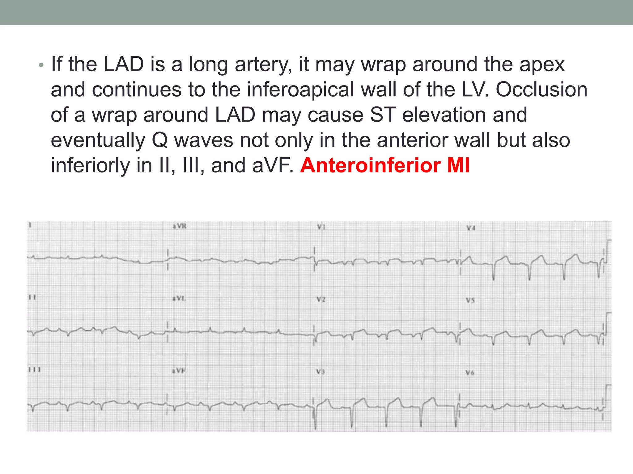 ECG in Acute Myocardial Infarction | PPTX