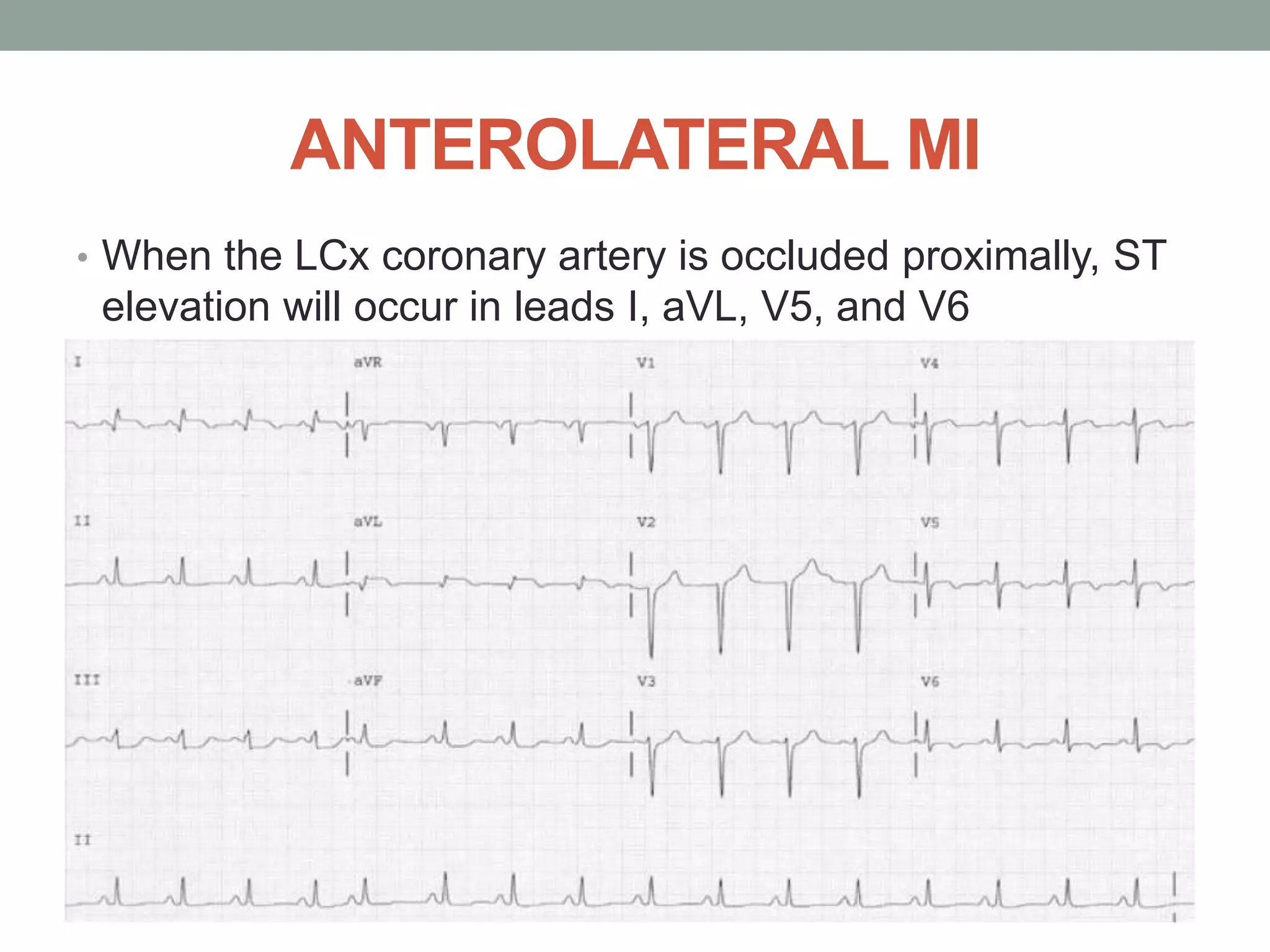 ECG in Acute Myocardial Infarction | PPTX