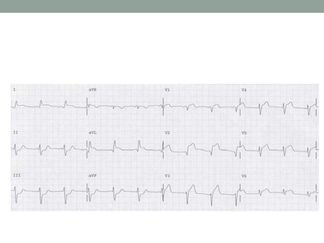 ECG in Acute Myocardial Infarction | PPTX