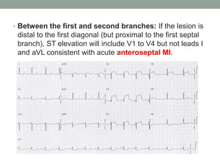 ECG in Acute Myocardial Infarction | PPTX