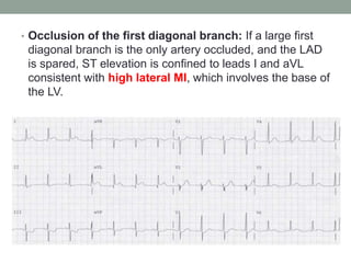 ECG in Acute Myocardial Infarction | PPTX