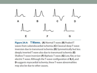 Acute Mi Ecg Tracing