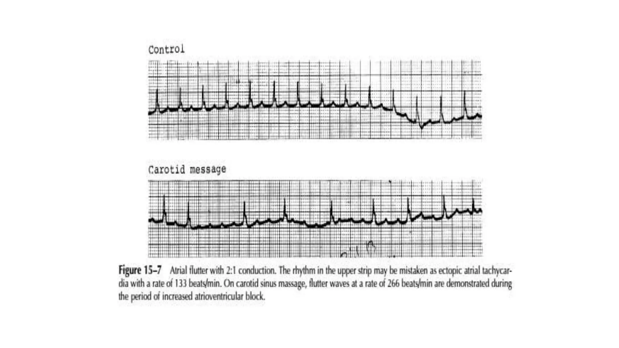 Ecg in aflutter | PPTX