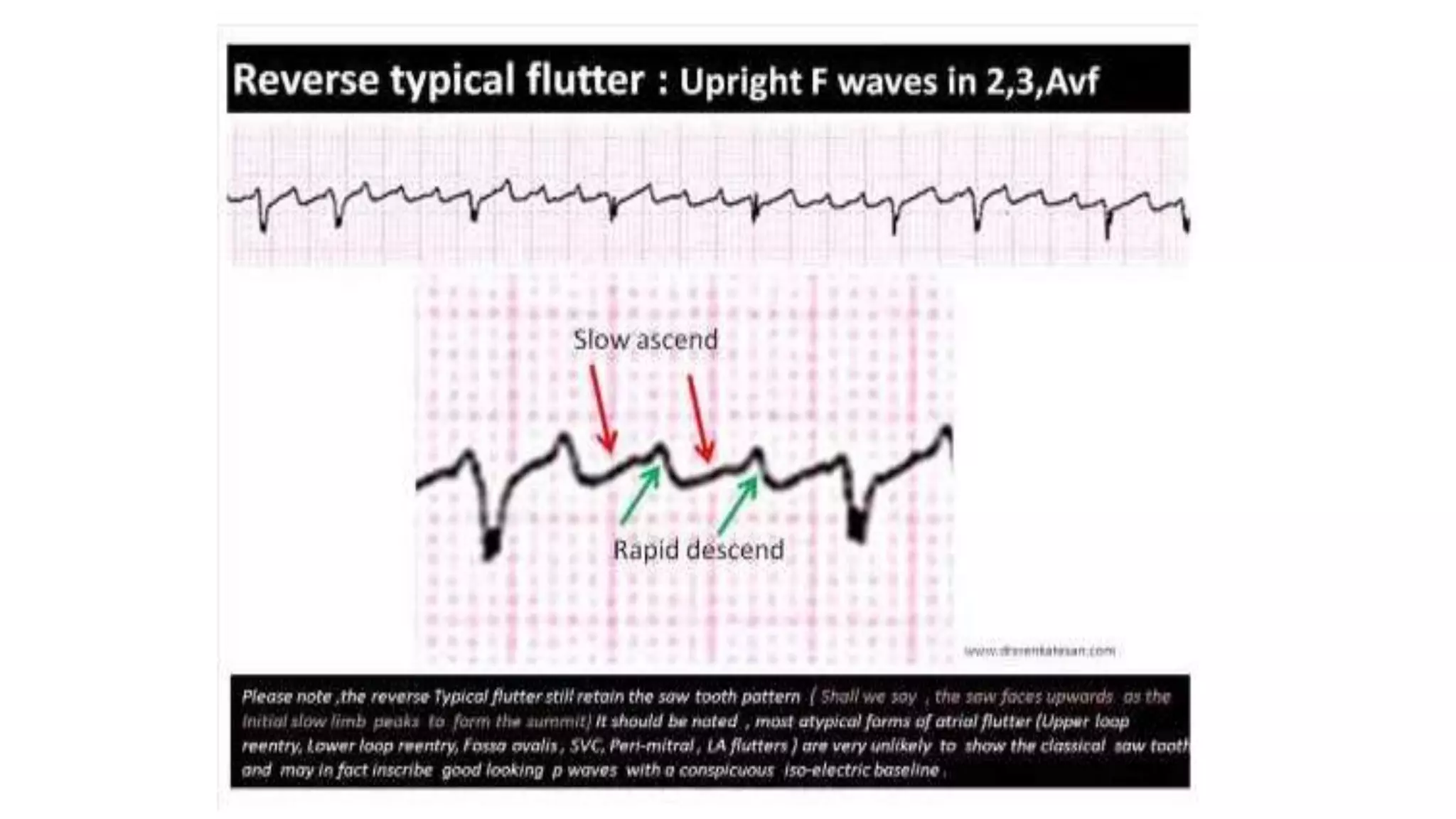 Ecg in aflutter | PPTX