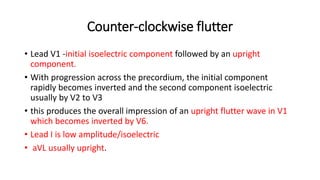 Ecg in aflutter | PPTX