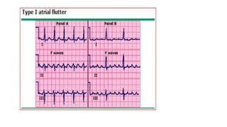 Ecg in aflutter | PPTX