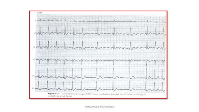 Ecg in aflutter | PPTX | Heart and Cardiovascular Diseases | Diseases ...