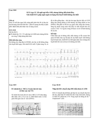 ECG in AMI | PDF
