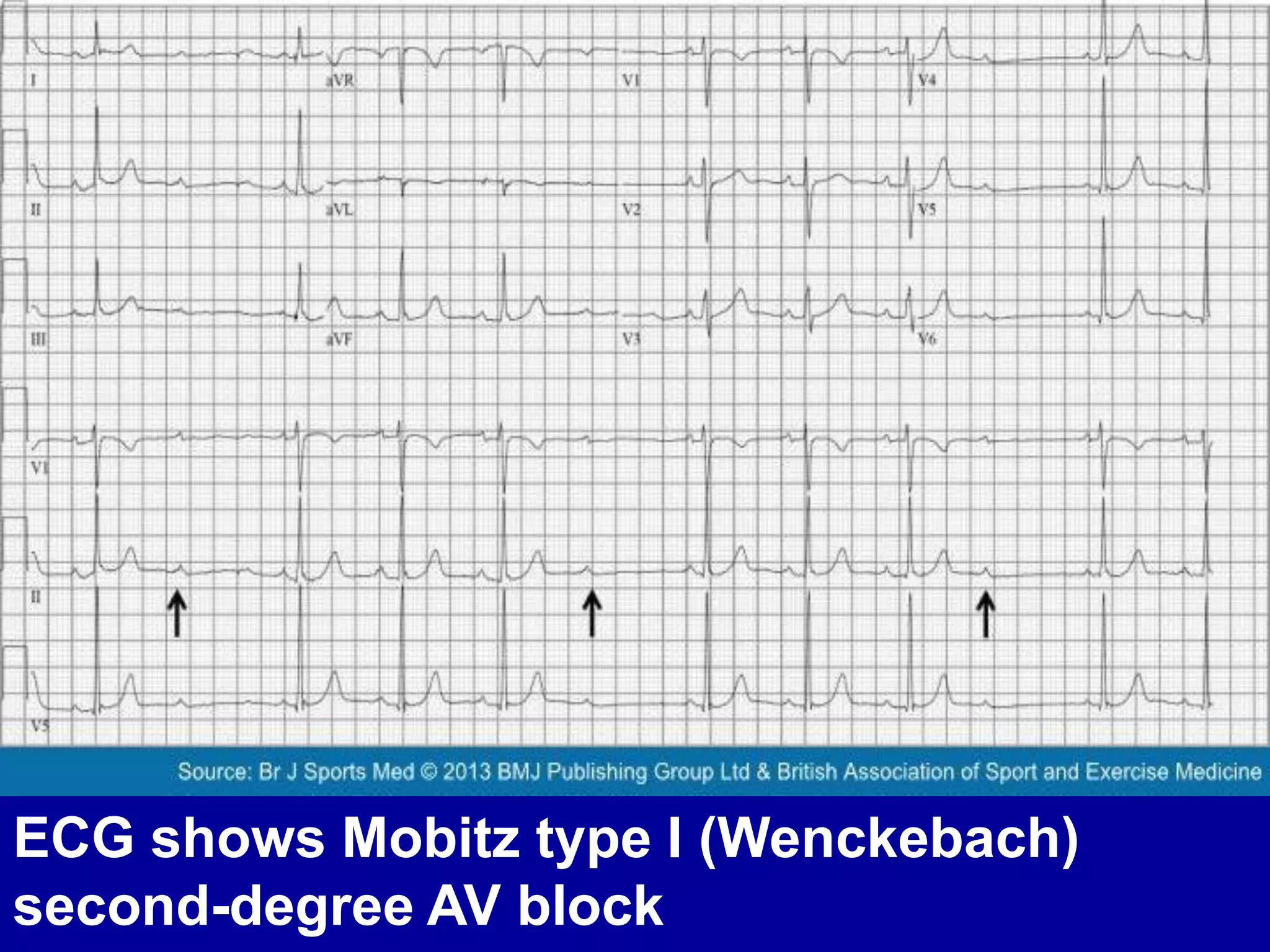Ecg in athletes limits of normal-samir rafla . cardio egypt 2015 | PPT