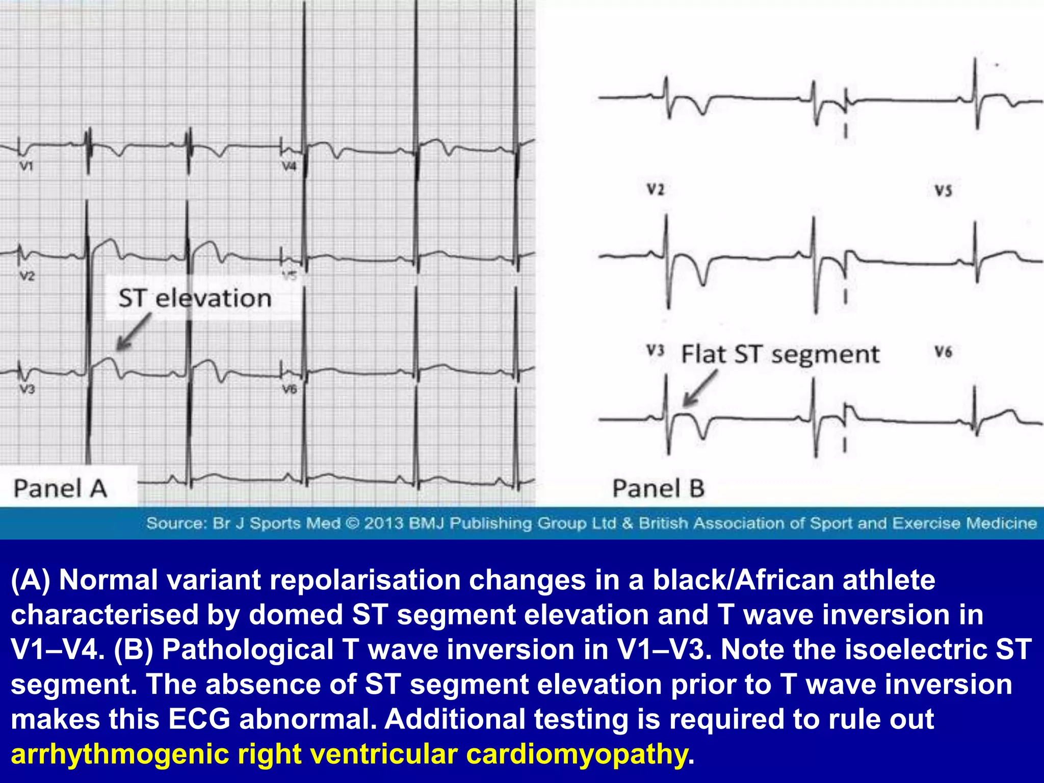 Ecg in athletes limits of normal-samir rafla . cardio egypt 2015 | PPT