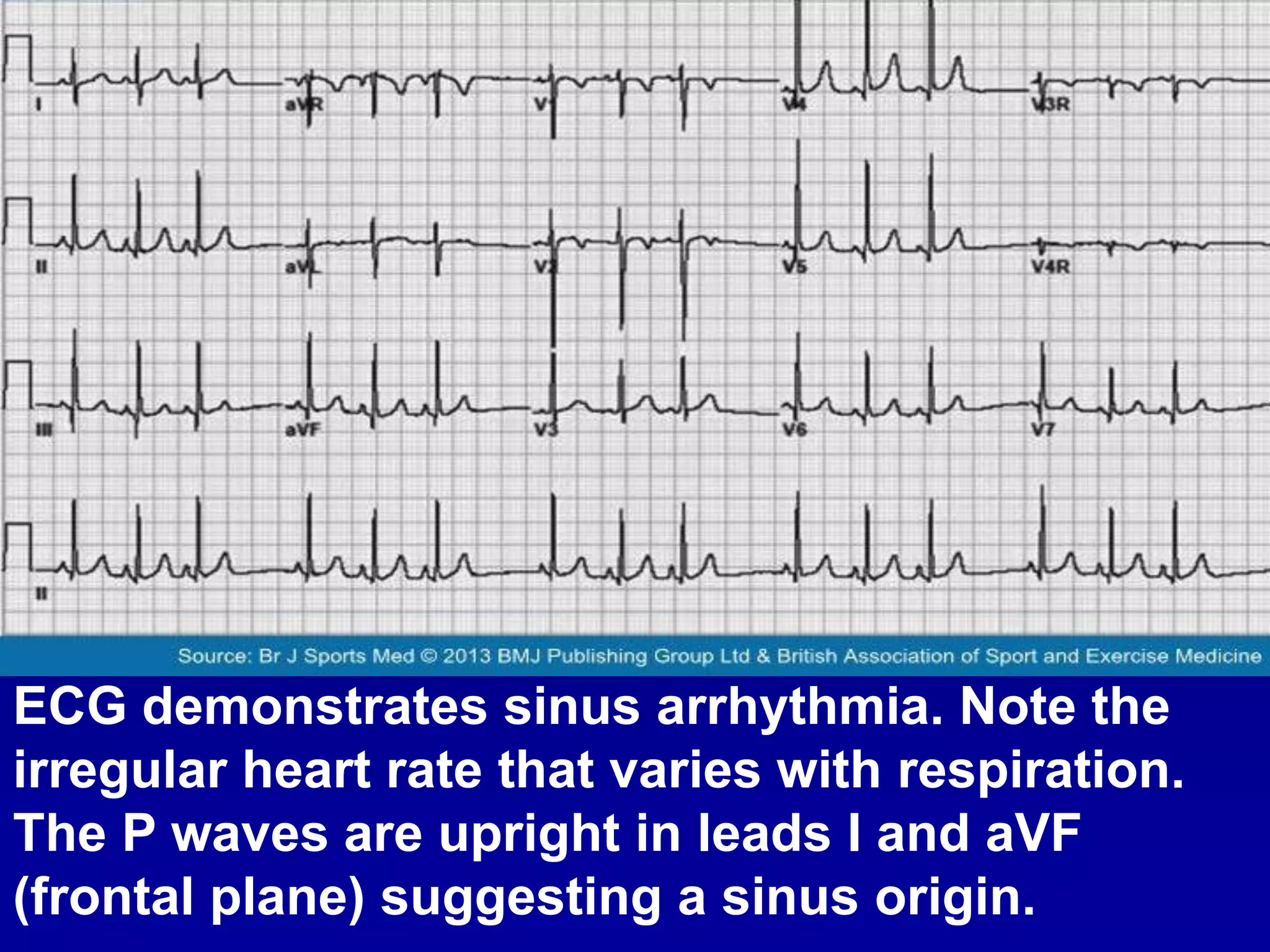 Ecg in athletes limits of normal-samir rafla . cardio egypt 2015 | PPT