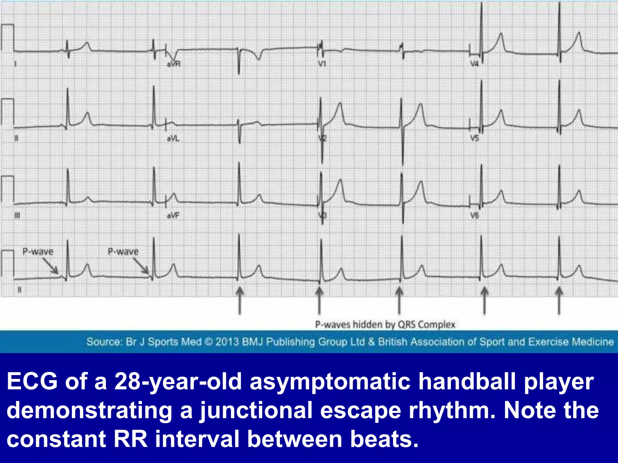 Ecg in athletes limits of normal-samir rafla . cardio egypt 2015 | PPT