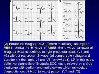 Ecg in athletes limits of normal-samir rafla . cardio egypt 2015 | PPT