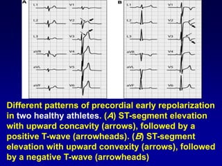 Ecg in athletes limits of normal-samir rafla . cardio egypt 2015 | PDF