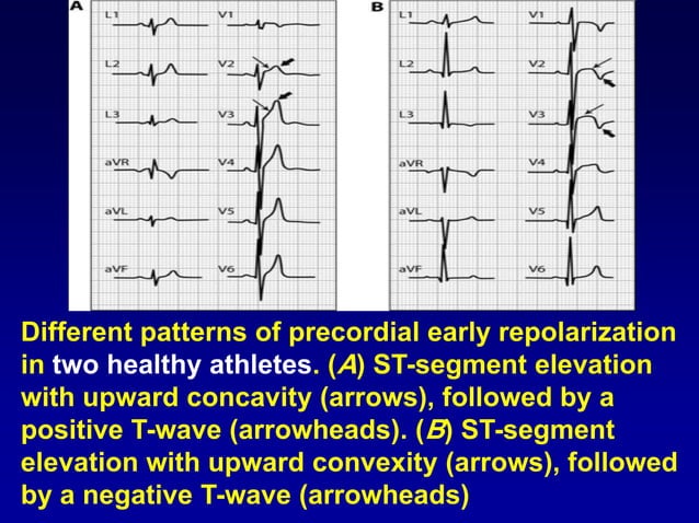 Ecg in athletes limits of normal-samir rafla . cardio egypt 2015 | PPT