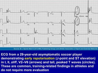 Ecg in athletes limits of normal-samir rafla . cardio egypt 2015 | PPT