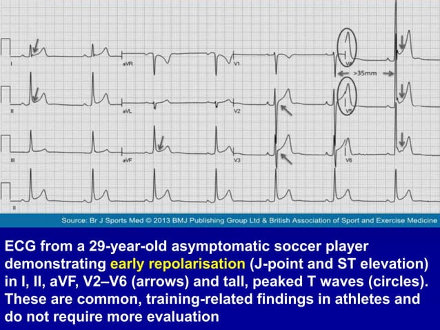 Ecg in athletes limits of normal-samir rafla . cardio egypt 2015 | PPT
