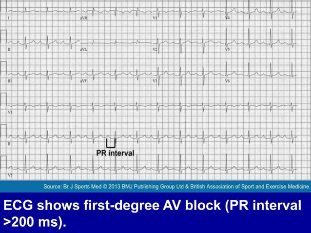 Ecg in athletes limits of normal-samir rafla . cardio egypt 2015 | PPT
