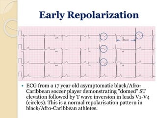 Ecg in athletes and young age | PPT