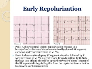 Ecg in athletes and young age | PPT