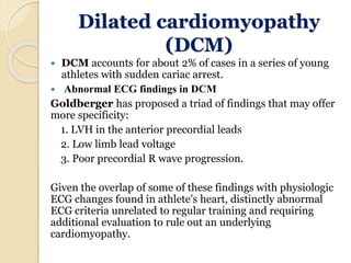 Dilated Cardiomyopathy Ecg